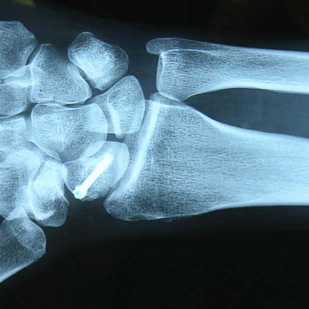 Fracture Du Scaphoïde [Zoom Sur]